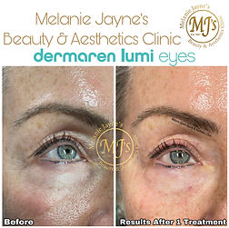 Lumi Eyes | mjsbeautyclinic
