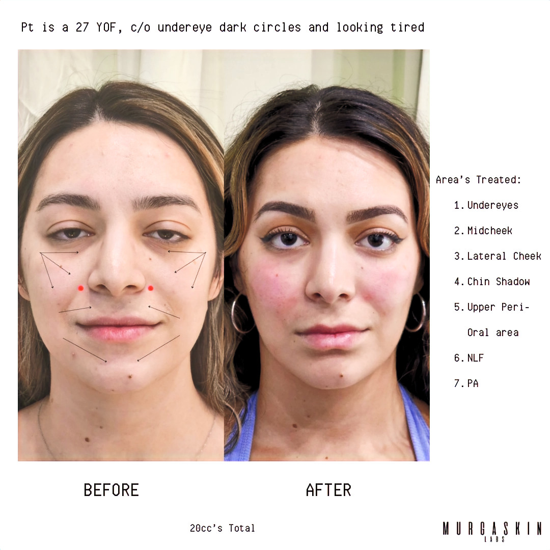 Derma PRP Filler vs. Hyaluronic Acid Fillers: Which is Right for You?