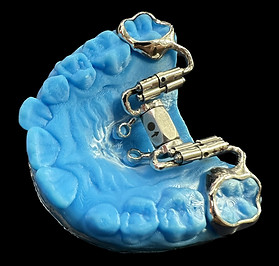 TAD System | Zan Ortho Lab