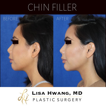 Chin Augmentation | Lisa Hwang, MD I Bay Area