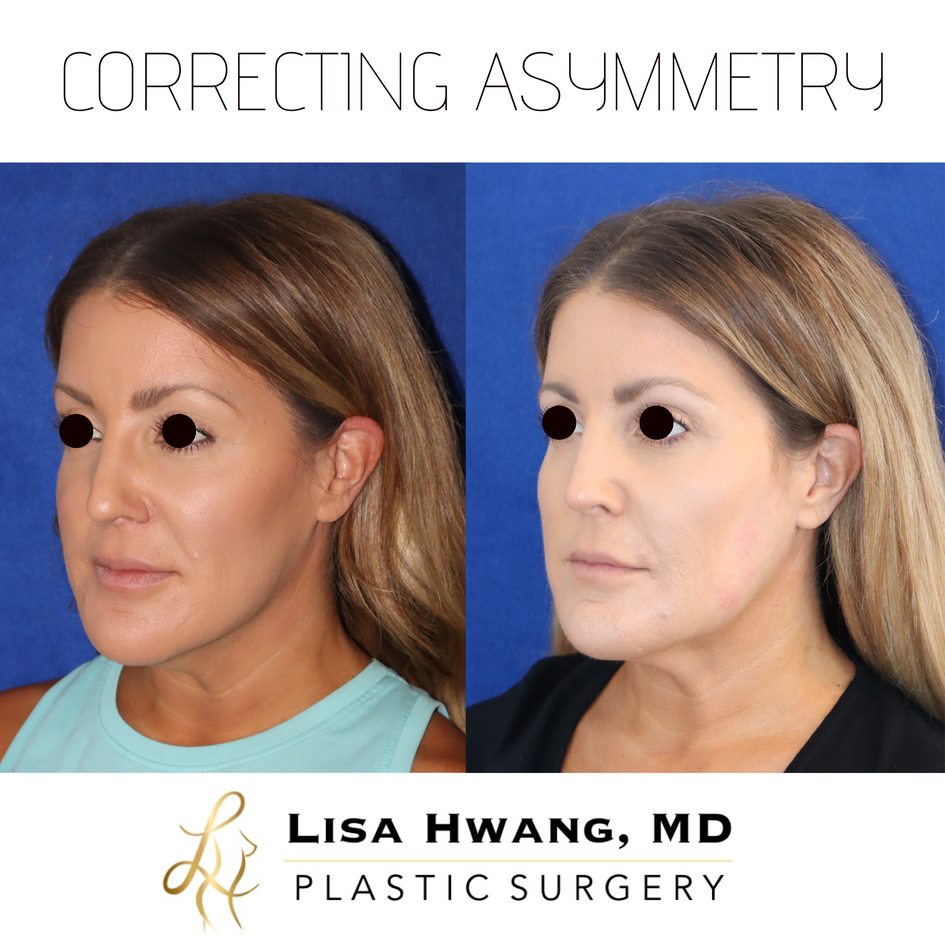 Dermal Fillers | Lisa Hwang, MD I Bay Area