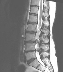 MRI bij rugklachten: inzicht en evaluatie! Hernia-weg