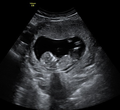 Early Scan | BabyScanUK