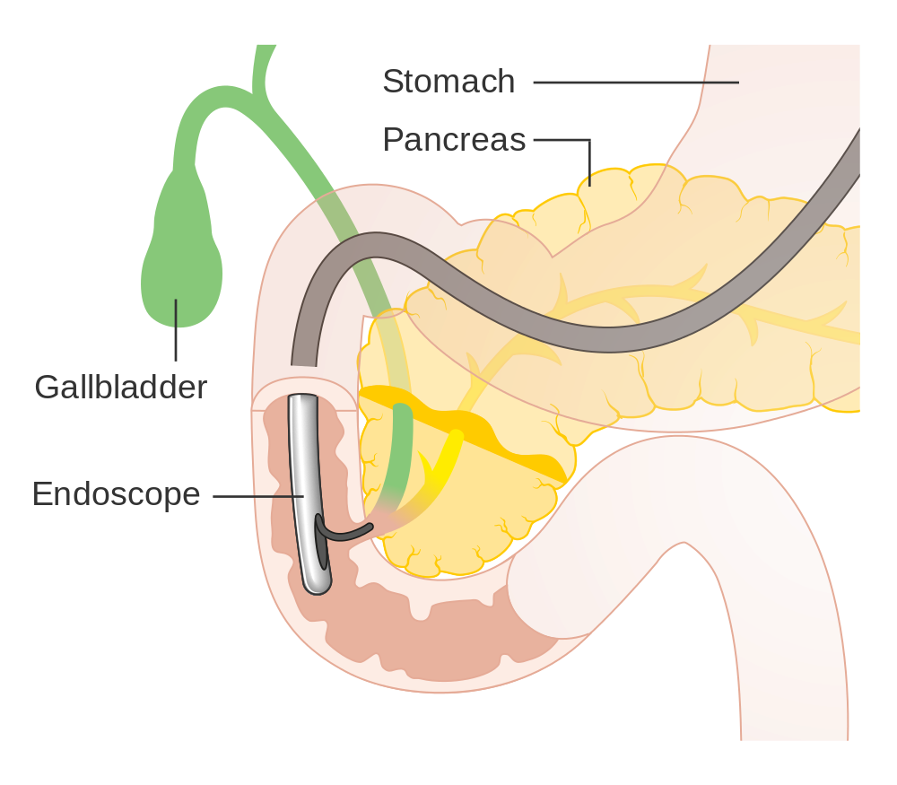 ERCP: Endoscopic Retrograde Cholangiopancreatography