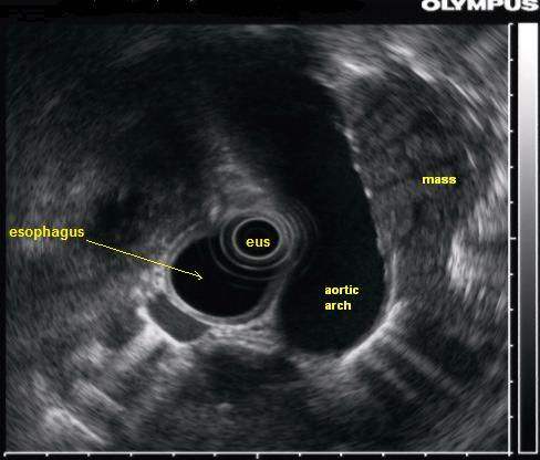 Endoscopic Ultrasound (EUS)