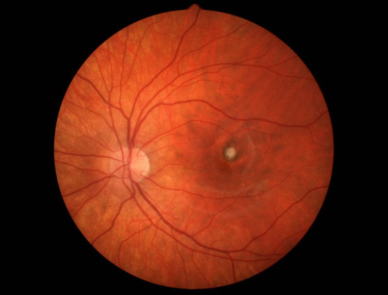 Punctate Inner Choroidopathy, the fun retinal disease that's killing my ...