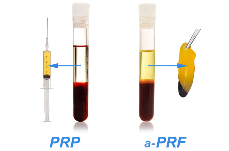 Understanding PRF: A Game-Changer in Aesthetic Medicine in Boston