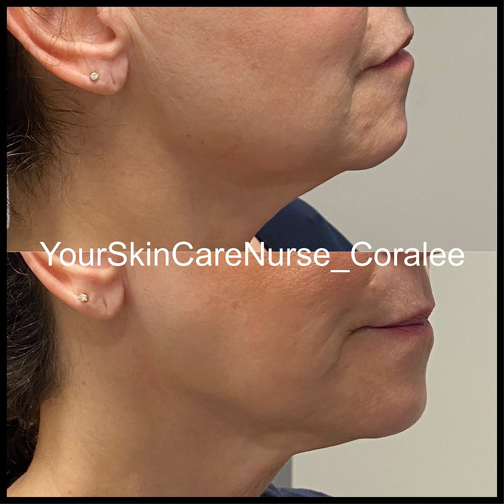 How to define the jawline