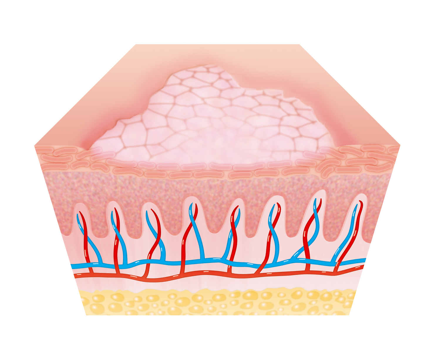 wound types | trigocare