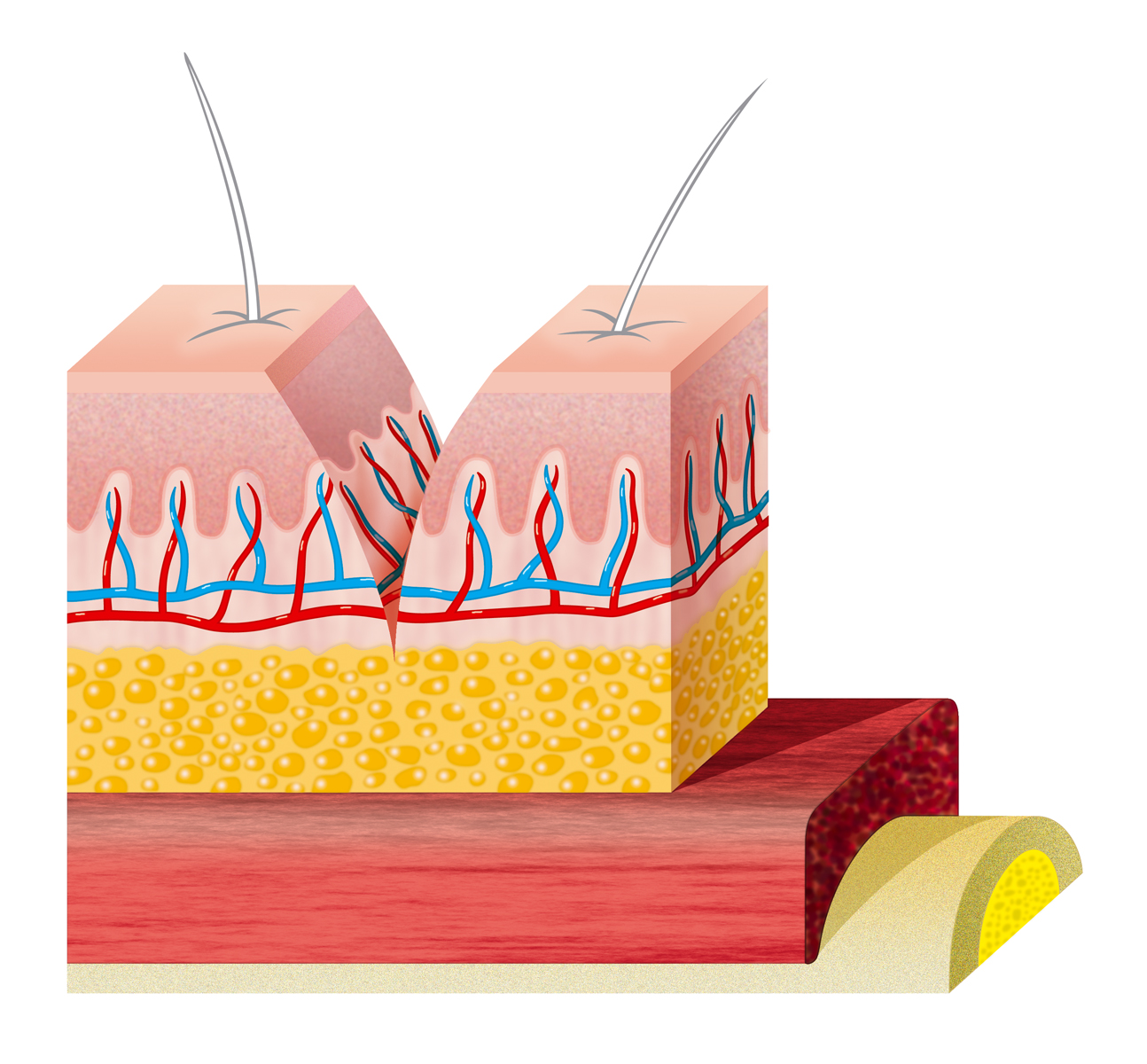 wound types | trigocare