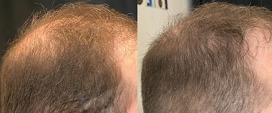 TED TREATMENTS | Triangle Trichology