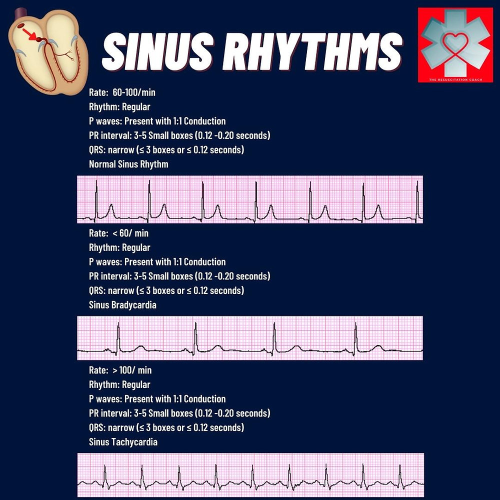 Sinus Rhythms