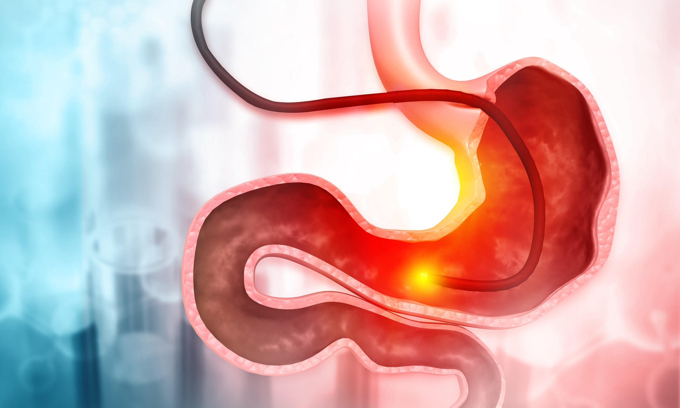 Esophagogastroduodenoscopy (EGD) | Riverside Gastroente