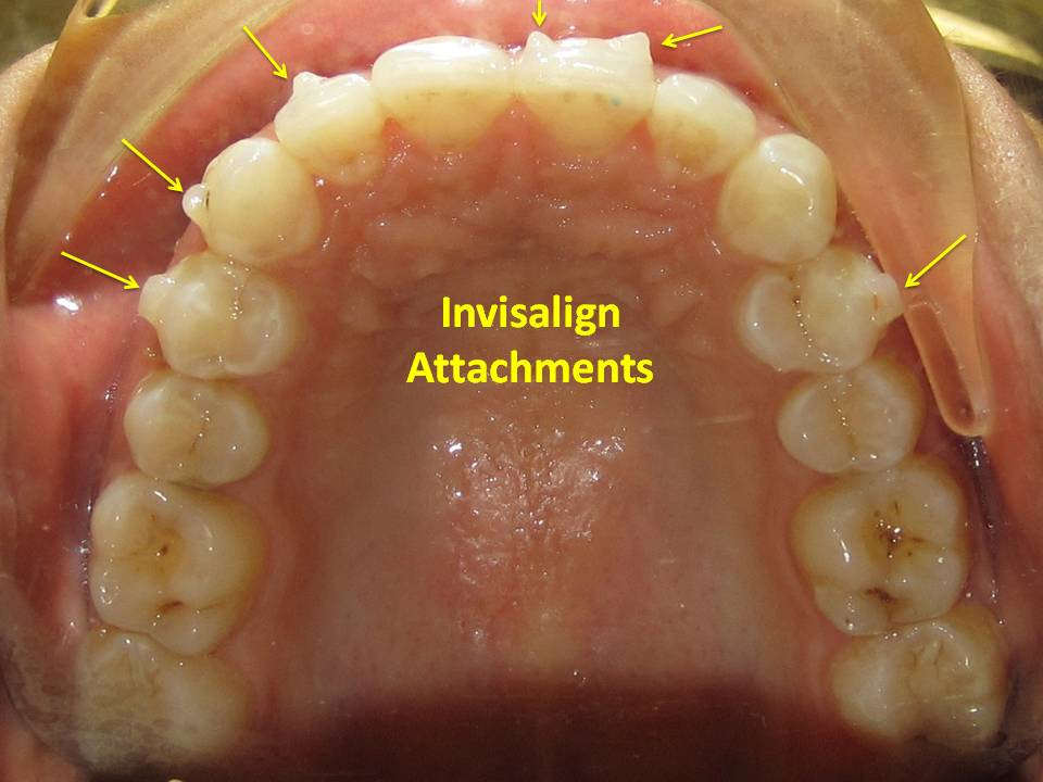 10 Things to Know about Invisalign in DC