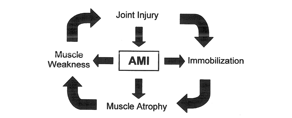 Arthrogenic Muscle Inhibition: An important consideration post ACLR