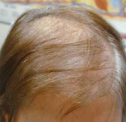 Before & Afters | XTC Hair Rejuvenation and Hair Growth System