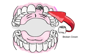 Buy Toofypegs Dental Temporary Repair Kit - £6.95 | Next Day Delivery