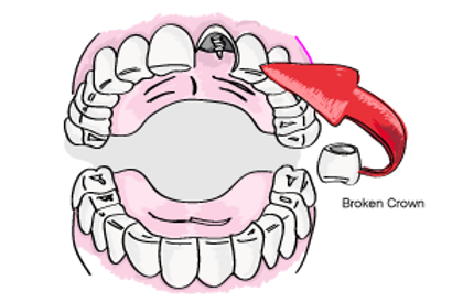 Toofypegs Dental Temporary Repair Kit | Hive Pharmacy