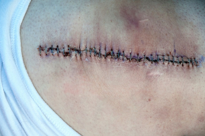 How do I know if my surgical incision is infected?