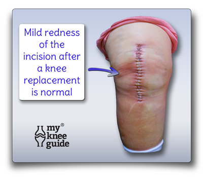 How do I know if my surgical incision is infected?