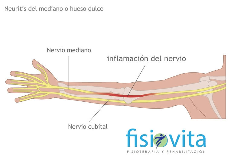 Neuritis del mediano o hueso dulce
