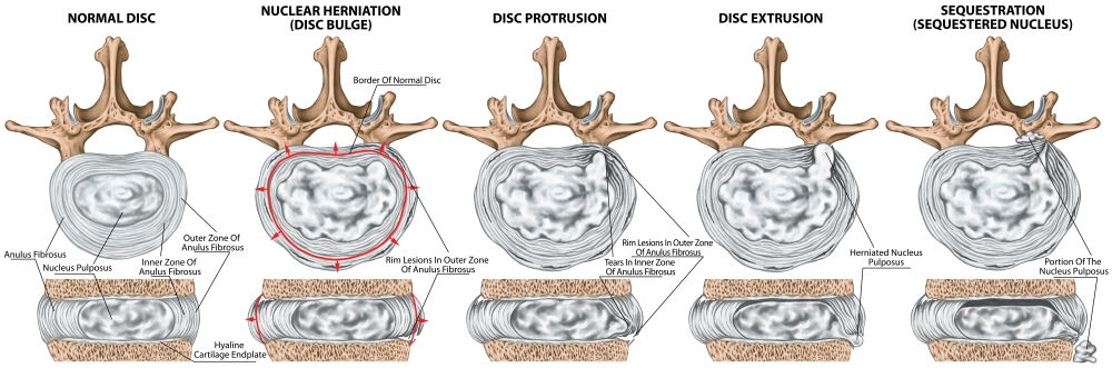 Lumbar Disc Injuries: How to Get Them to Heal. PART 1.