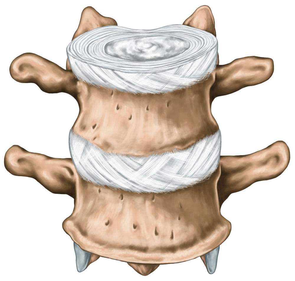 Lumbar Disc Injuries: How to Get Them to Heal. PART 1.