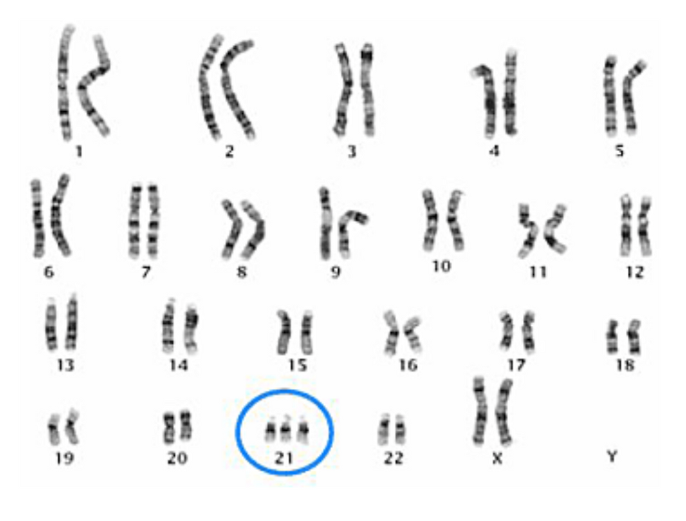 Introduction to Down Syndrome