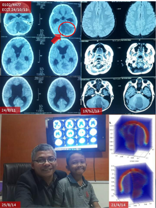 A 9-year-old boy with Pilocytic Astrocytoma Triumph Over Brain Tumor ...