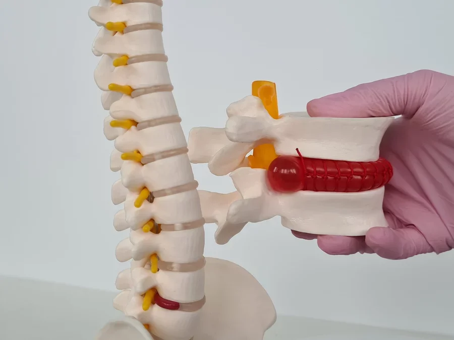 Artificial Disc Replacement: A Worthy Alternative to Spinal Fusion