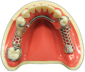 Cobalt Chrome Dentures | A P Cargill | Middlesbrough