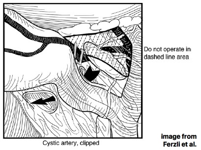 Node of Calot. A landmark to reduce bile duct injury during ...