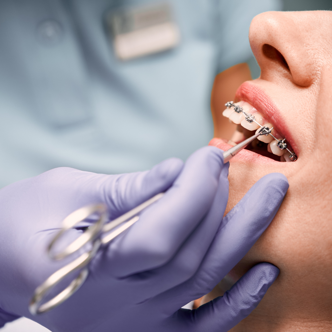Brackets | Dentaler