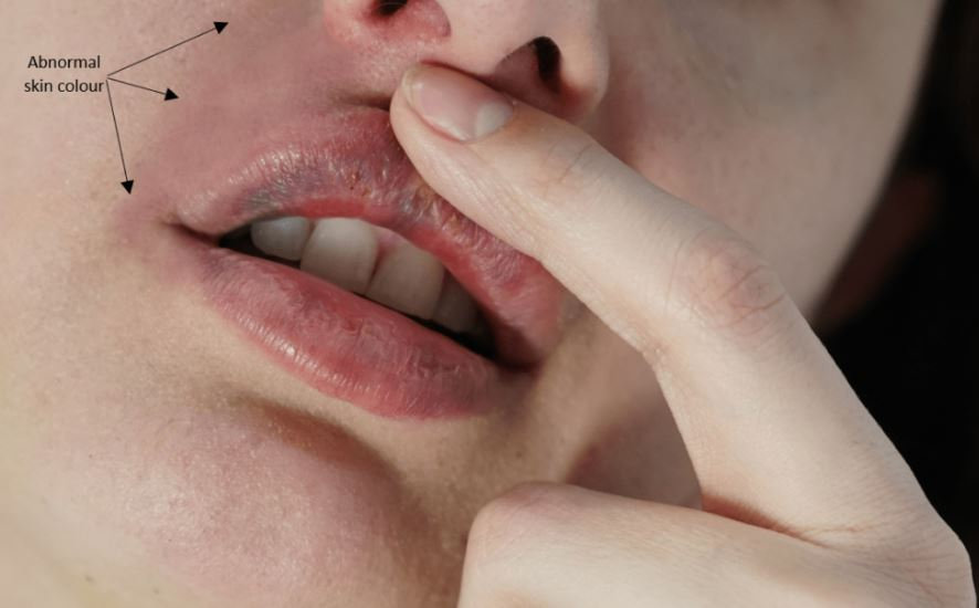 # Understanding Vascular Occlusion: A Vital Aspect of Lip Treatments