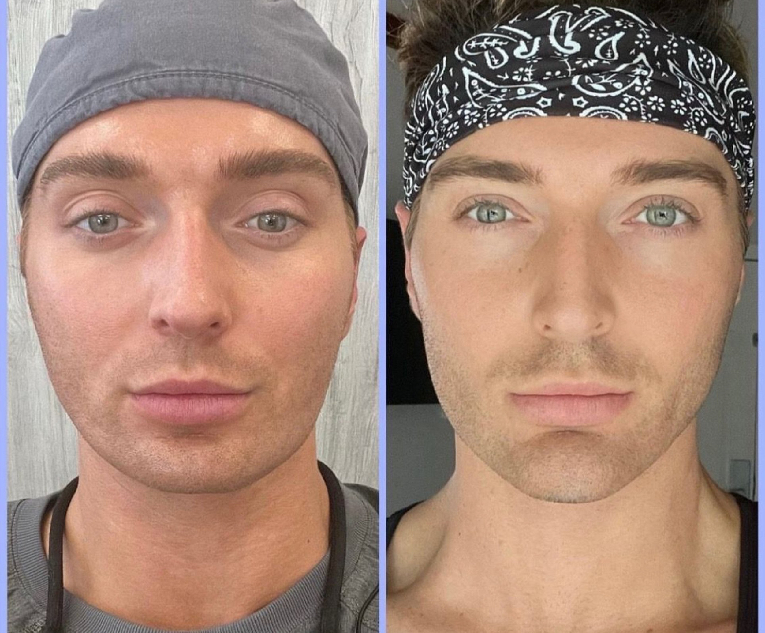 Chin Filler Miami | Best injector Miami | Randy Lindgren MD