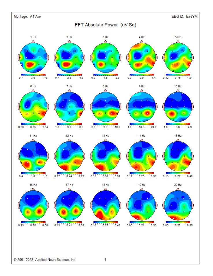 A Guide to Interpreting EEG Topographic Maps