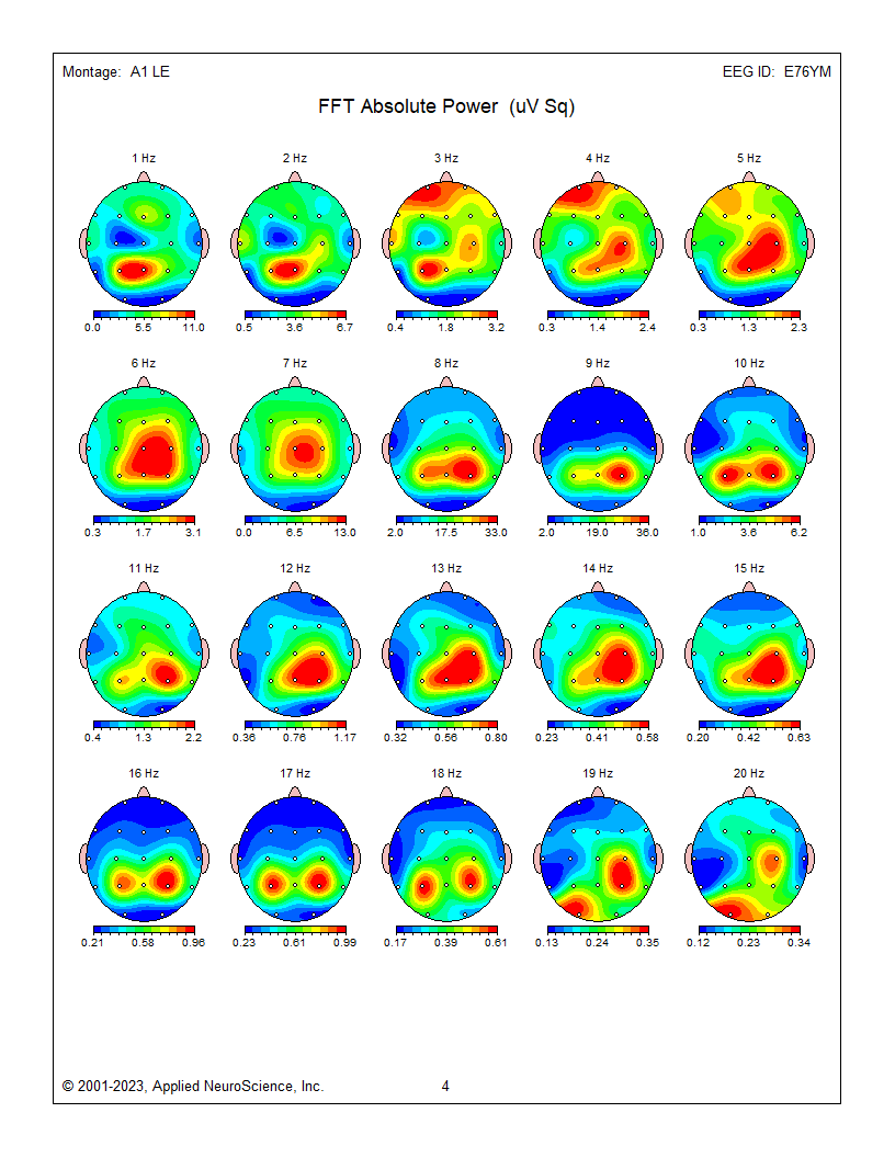 A Guide to Interpreting EEG Topographic Maps