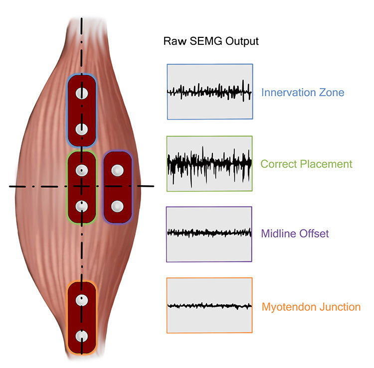 Why You Should Place EMG Sensors on the Muscle Belly