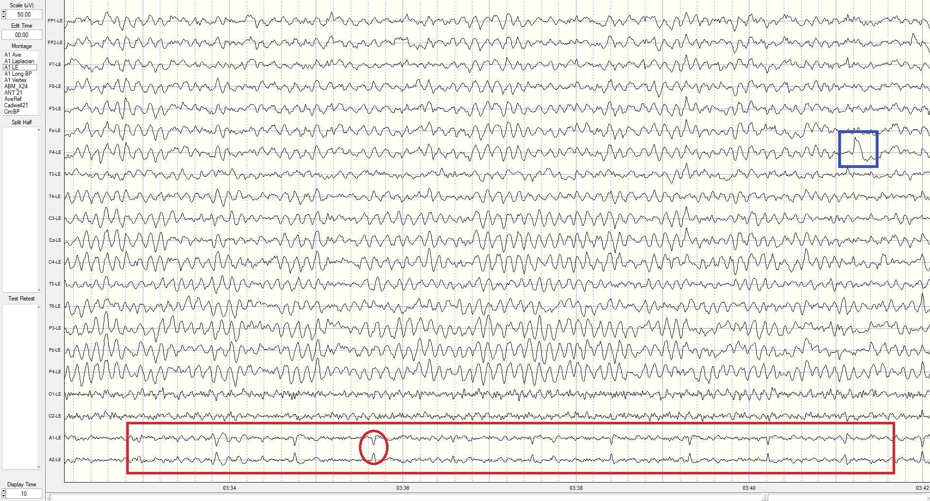 A Guide to Interpreting EEG Topographic Maps