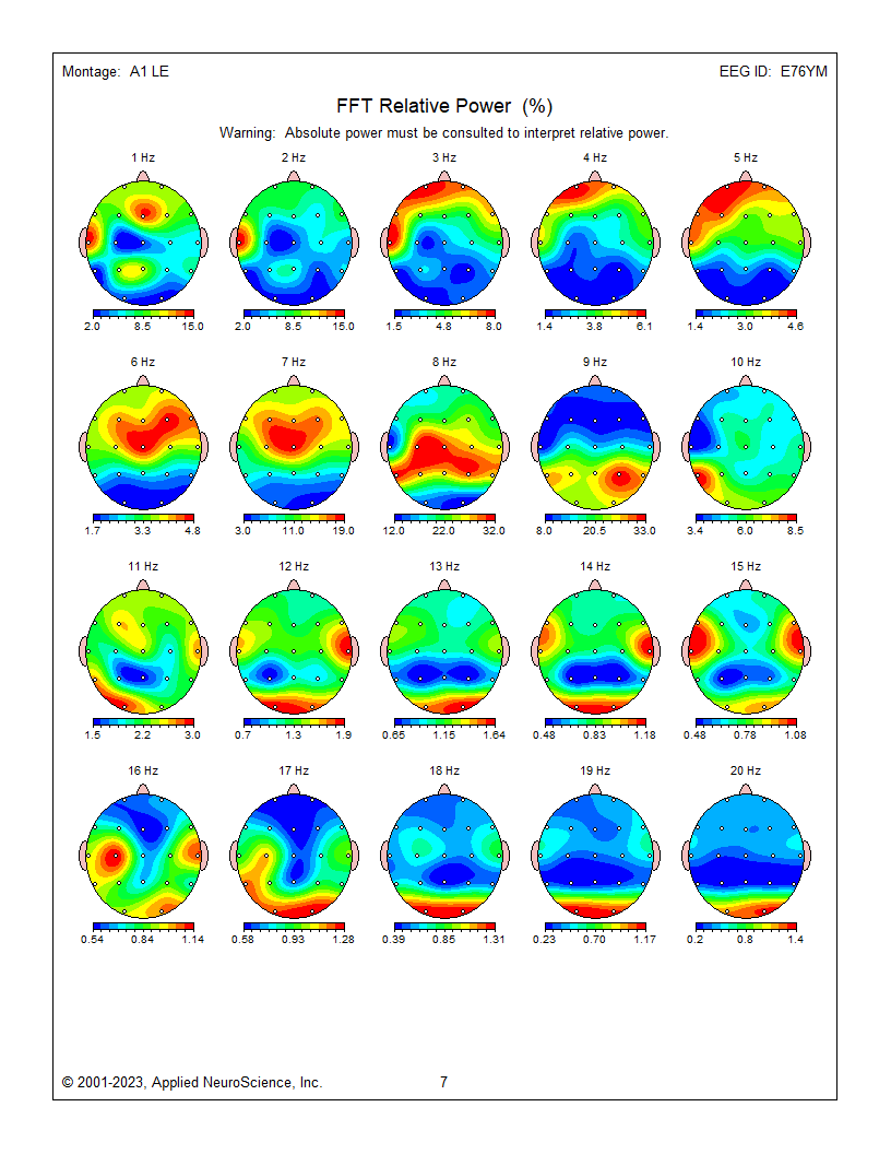 A Guide to Interpreting EEG Topographic Maps