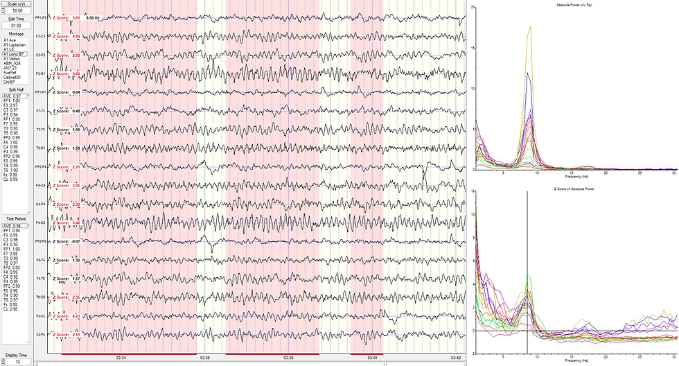 A Guide to Interpreting EEG Topographic Maps