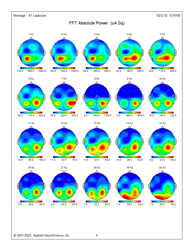 A Guide to Interpreting EEG Topographic Maps