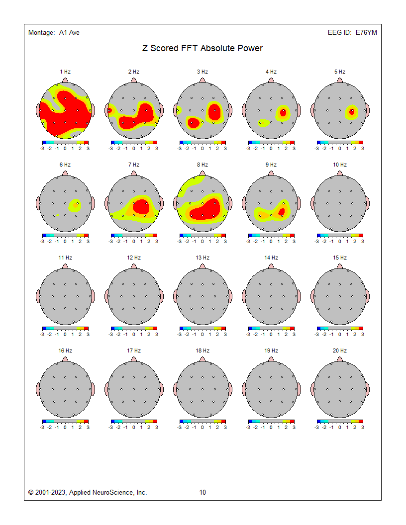 A Guide to Interpreting EEG Topographic Maps