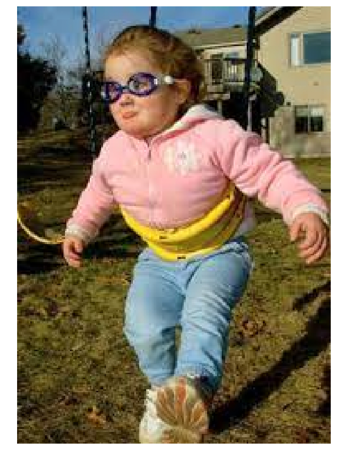 Congenital Insensitivity to Pain and Anhidrosis Syndrome