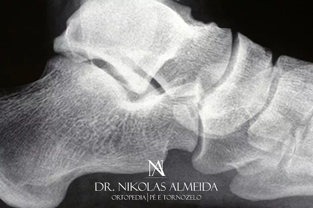 Entesófito Plantar No Calcâneo - BRAINCP