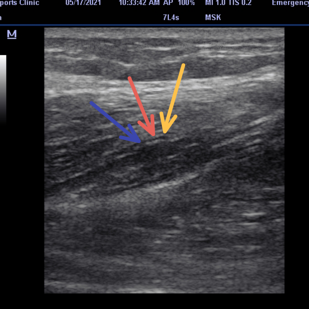 Injury Prevention with MSK Ultrasound