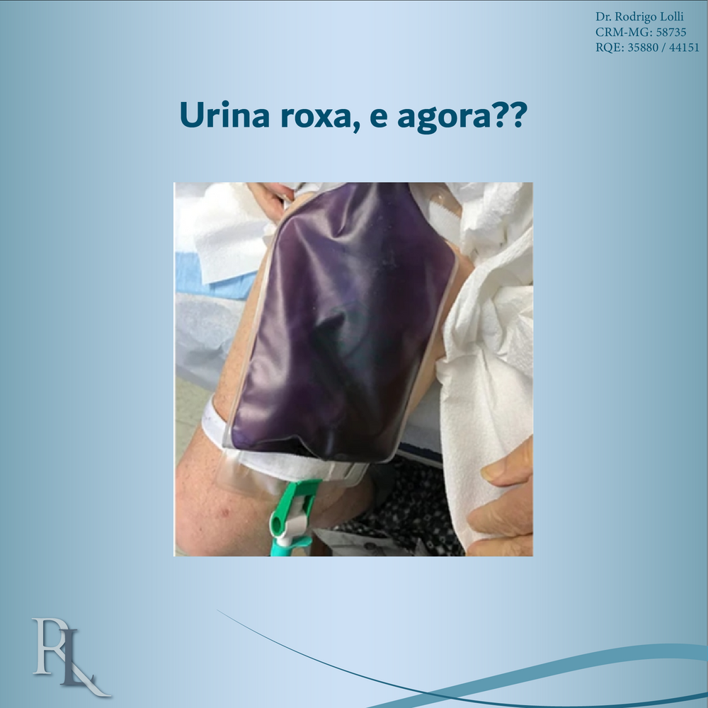 Urina roxa, e agora?
