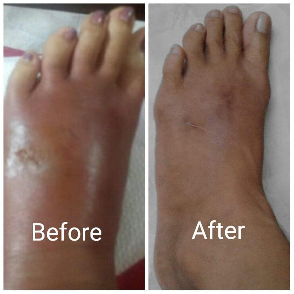 HYPERACIDITY, INSOMNIA & SWOLLEN FEET