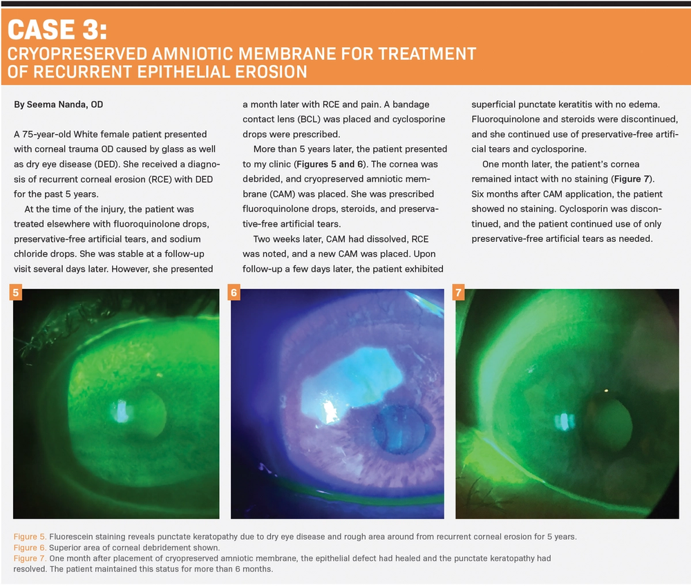 Guideline Redefines Amniotic Membrane’s Role in Ocular Surface Disease