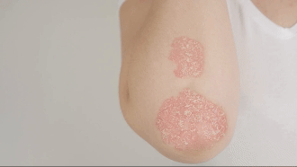 World Psoriasis Day: Understanding Psoriasis and How to Manage It